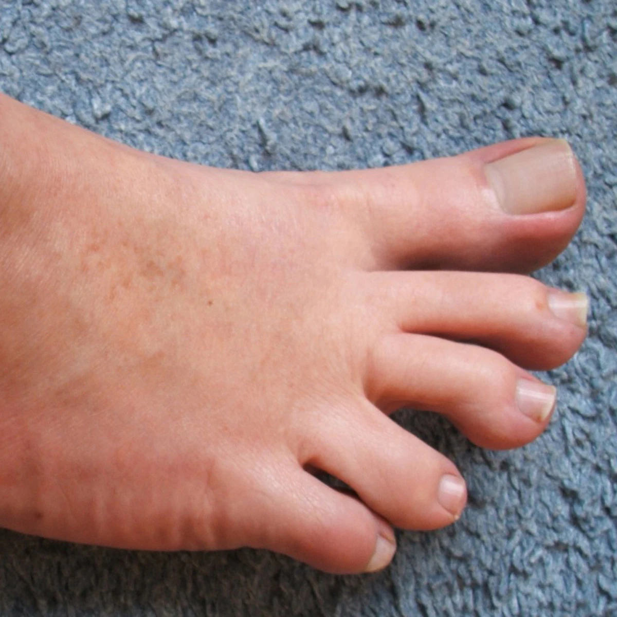 5 Common Toe Problems and Their Causes | Beauty Launchpad