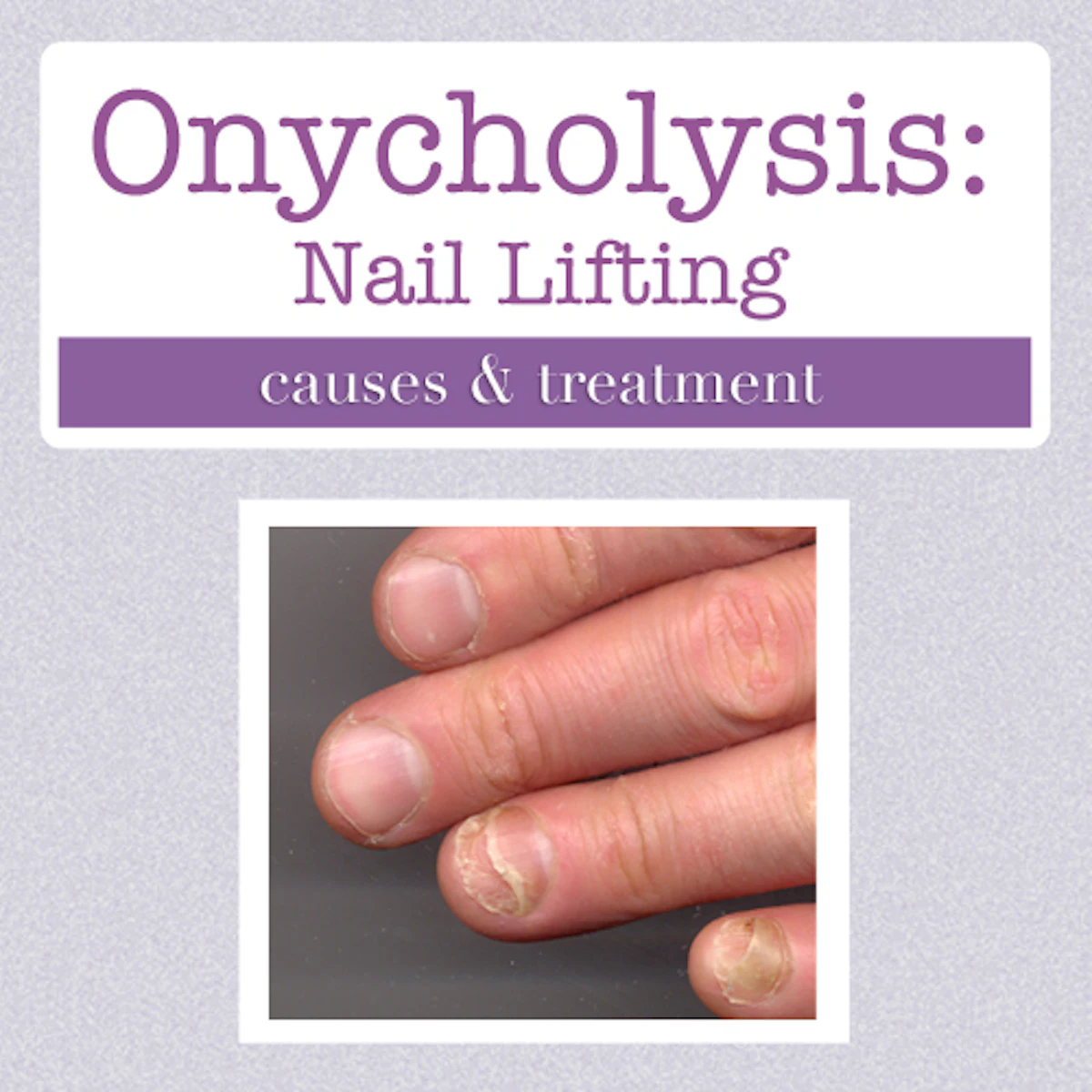 Nail Clinic: Onycholysis: What It Looks Like, Causes, and Treatment ...