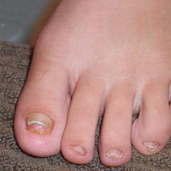 Nail Clinic: Atrophy of the Nail | Beauty Launchpad