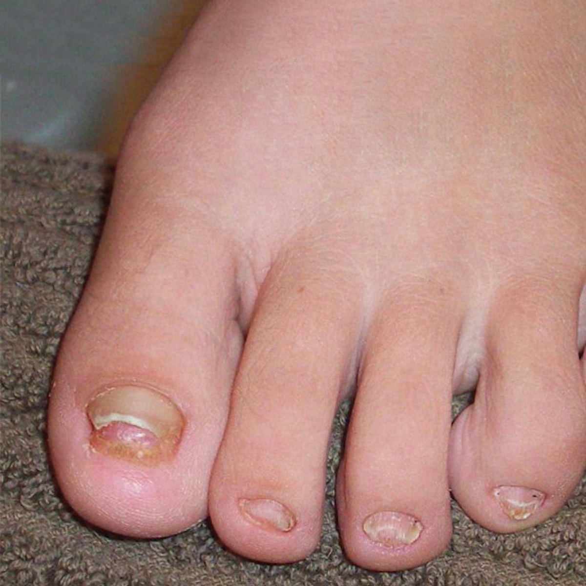 Nail Clinic: Atrophy of the Nail | Beauty Launchpad